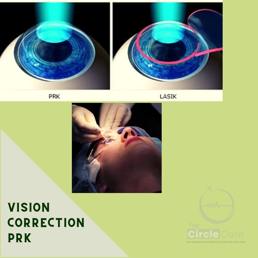 Vision Correction PRK - تصحيح الإبصار PRK - ذا سيركل كير